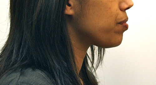 Orthodontics Before and After - Real Orthodontic Patient Photographs