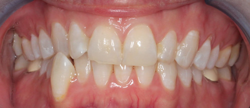 Orthodontics Before and After - Real Orthodontic Patient Photographs