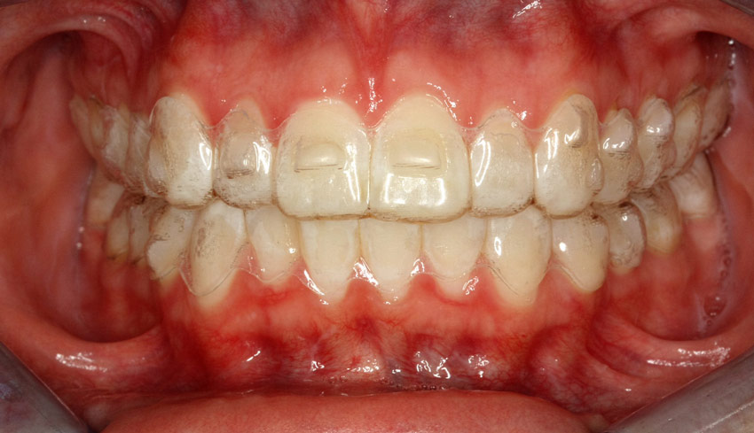 Invisalign - Abraham Orthodontics - Kingsville ON, Leamington ON